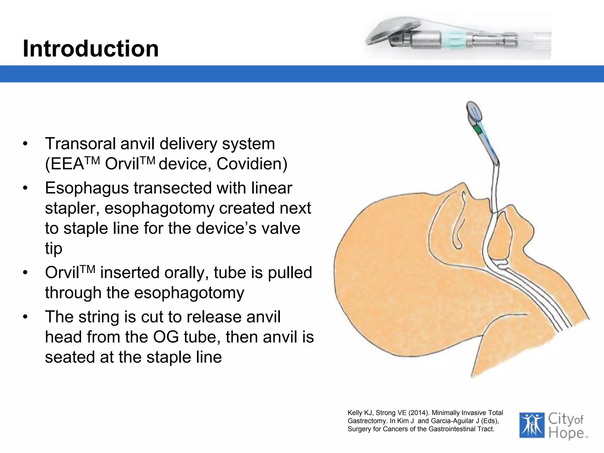 Outcomes Using Double-Staple Technique for Esophagoenteric Anastomosis ...