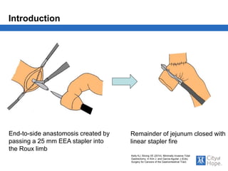 Outcomes Using Double-Staple Technique for Esophagoenteric Anastomosis ...