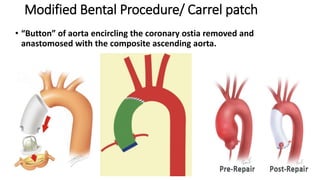 Ascending aorta surgical repair techniques | PPTX | Heart and ...