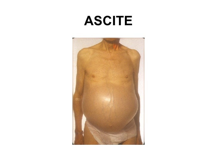 Ascite