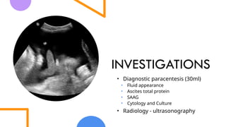 ASCITES-1.study of mechanisms of ascites fluid formation | PPT