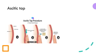 ASCITES-1.study of mechanisms of ascites fluid formation | PPT
