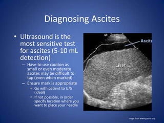 Ascites and SBP | PPT