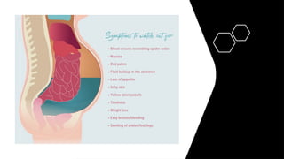 Ascites - Intro, Causes, Pathophysiology , Signs and Symptoms ...