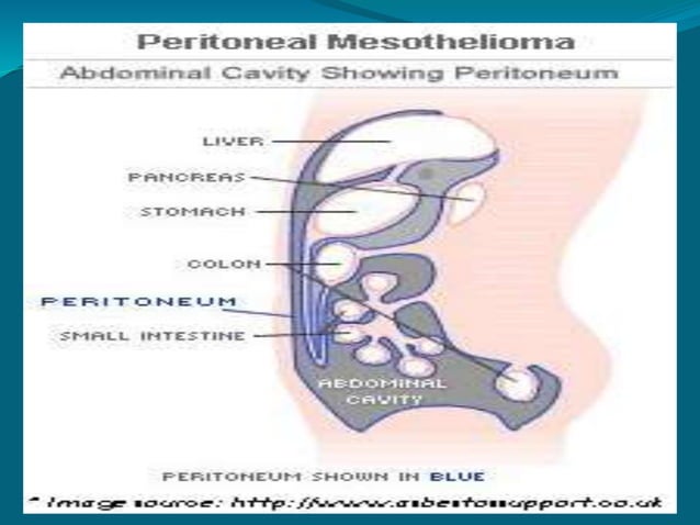 ascites-mu1.ppt case presentation of ascites | PPT