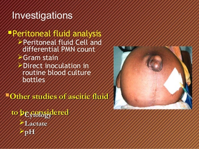 Ascites by_ Dr Mohammed Hussien