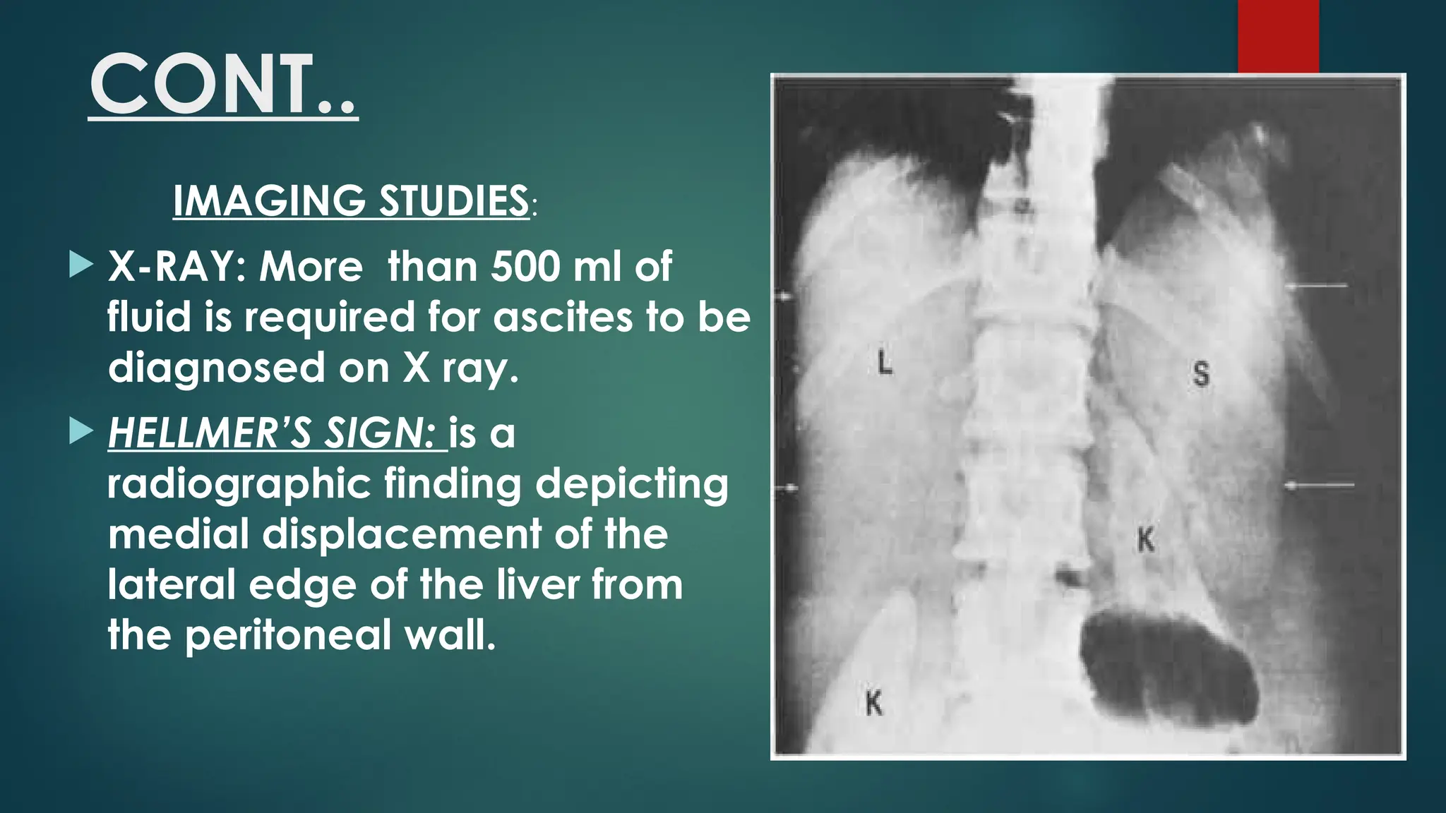 ASCITES IN CHILDREN. powerpointpresentation | PPTX