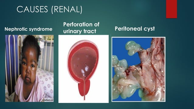 ASCITES IN CHILDREN. powerpointpresentation | PPTX | Digestive ...
