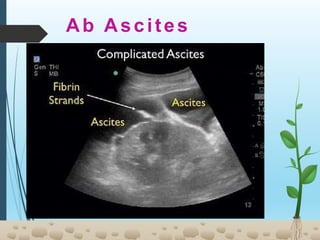 Ascites in ultrasound.pdf Ascites, ultrasound, diagnose | PDF