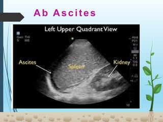 Ascites in ultrasound.pdf Ascites, ultrasound, diagnose | PDF