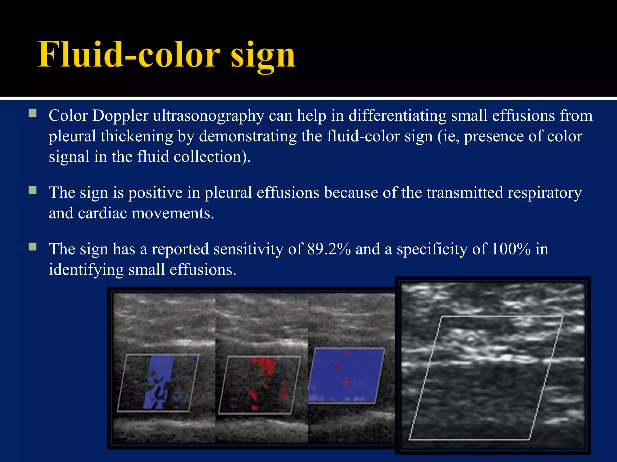 Ascites and Pleural Effusion | PPT