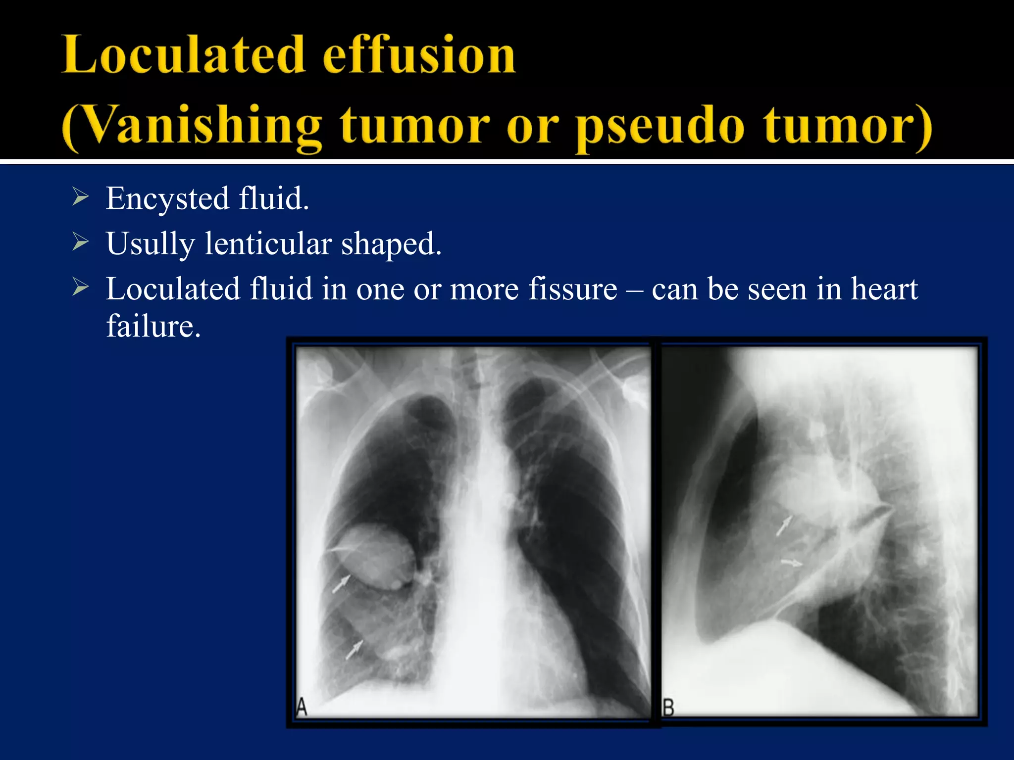 Ascites and Pleural Effusion | PPT
