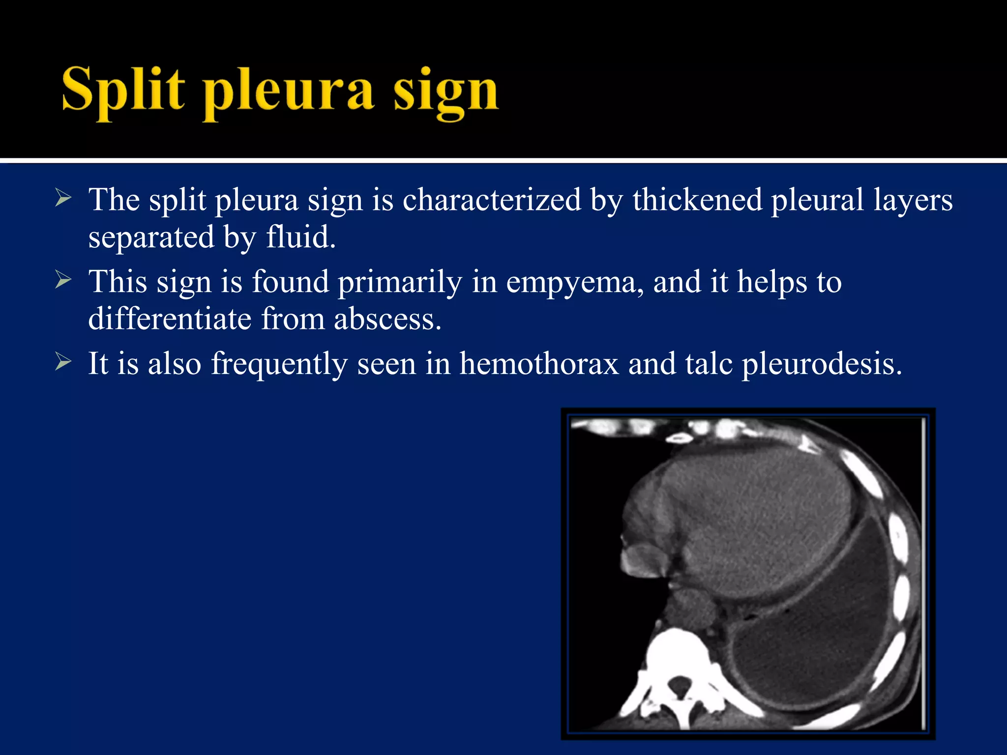 Ascites and Pleural Effusion | PPT