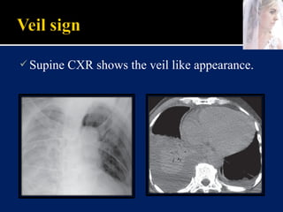 Ascites and Pleural Effusion | PPT