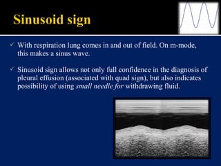 Ascites and Pleural Effusion | PPT