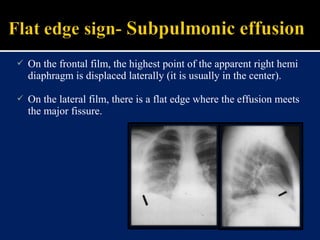 Ascites and Pleural Effusion | PPT
