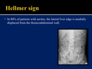 Ascites and Pleural Effusion | PPT