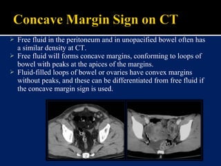 Ascites and Pleural Effusion | PPT
