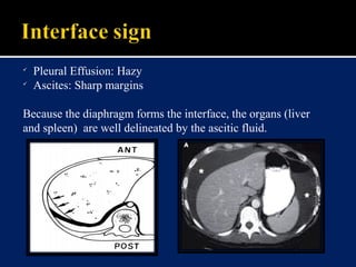 Ascites and Pleural Effusion | PPT