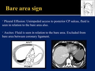 Ascites and Pleural Effusion | PPT