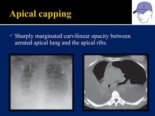 Ascites and Pleural Effusion | PPT