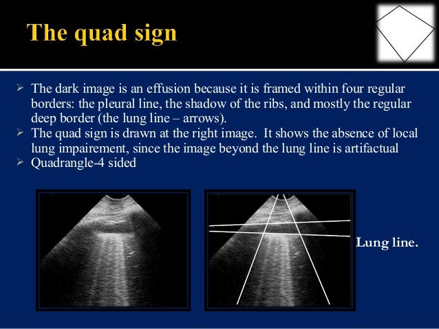 Ascites and Pleural Effusion