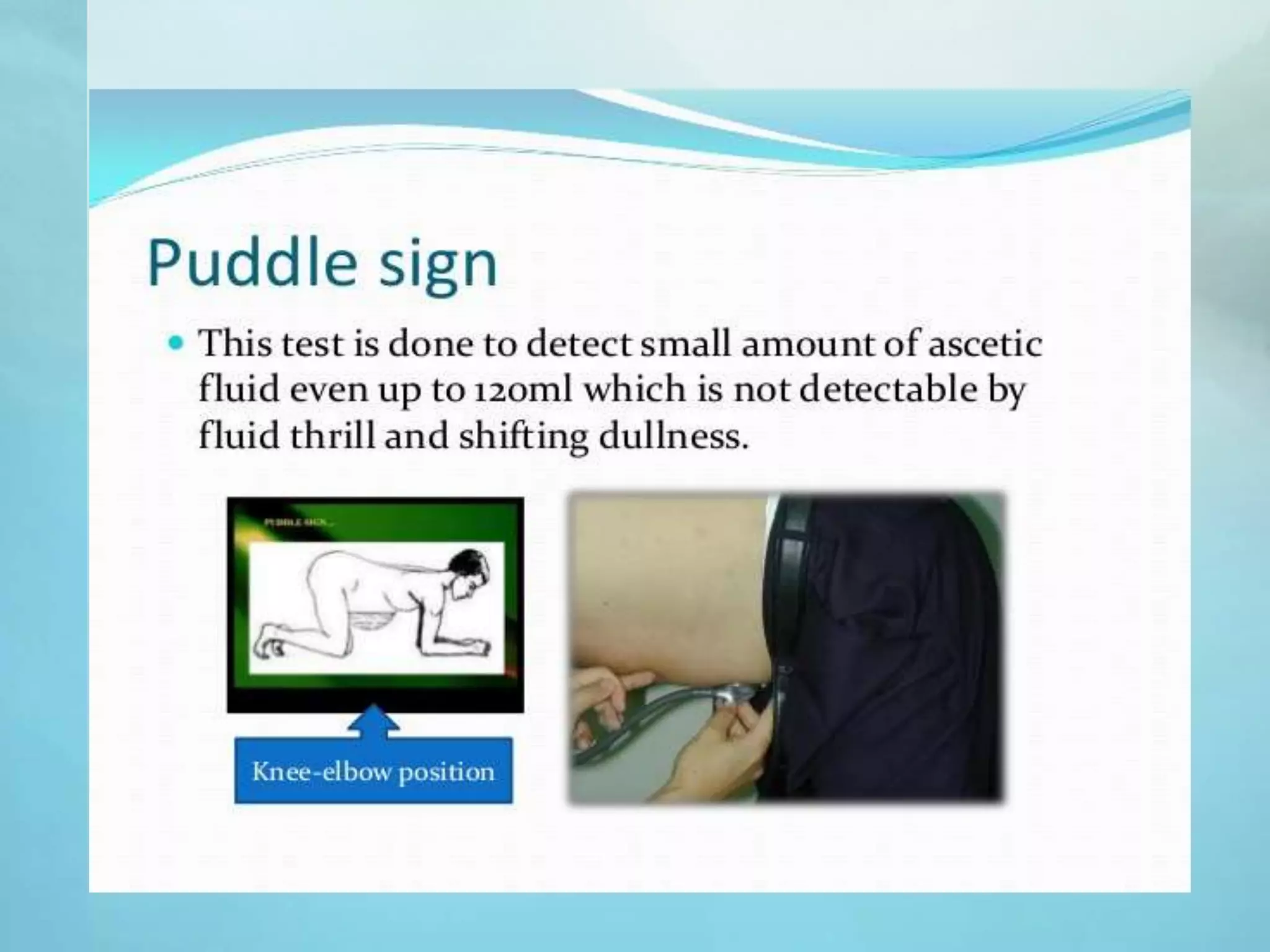 Ascites ppts | PPTX