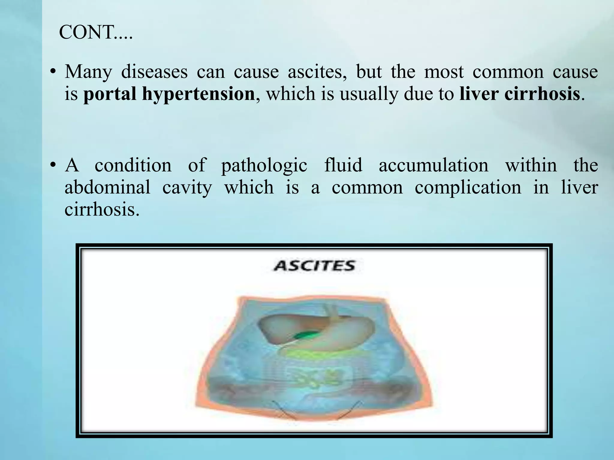 Ascites ppts | PPTX