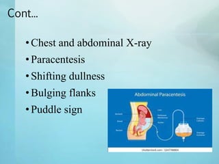 Ascites ppts | PPTX