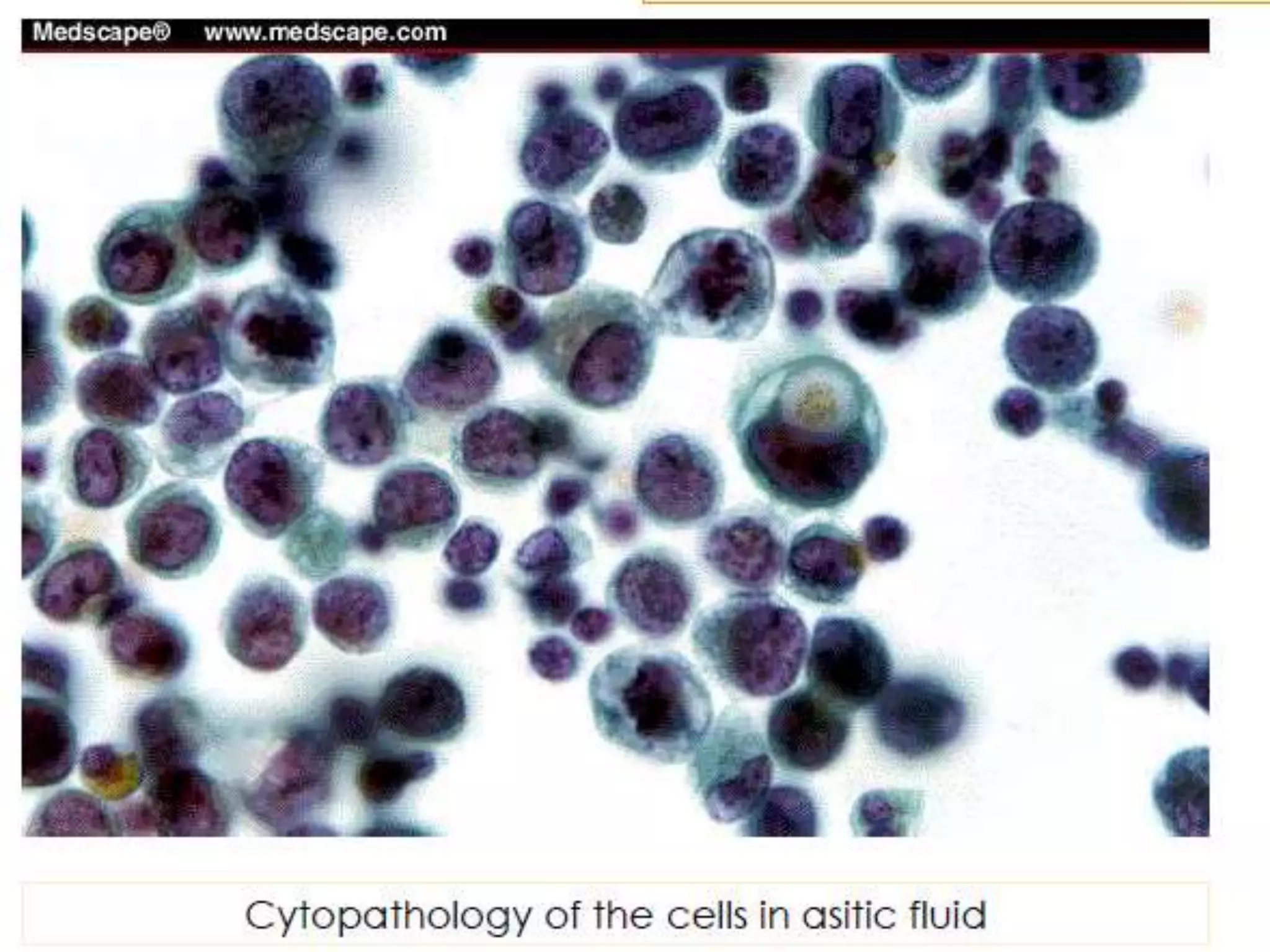 Ascitic fluid examination | PPTX