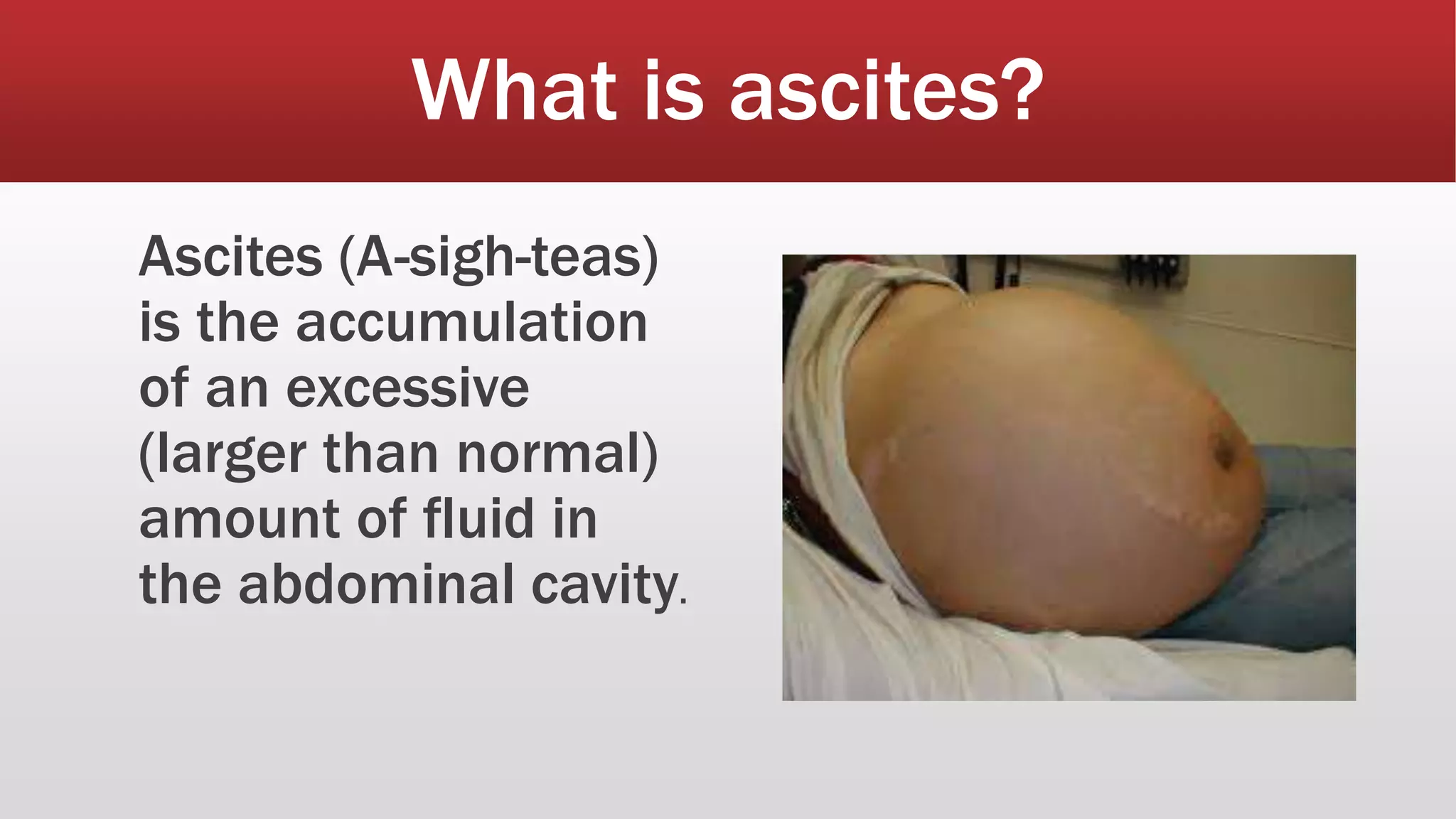 Ascitic tap or paracentesis | PPTX