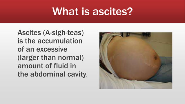 Ascitic tap or paracentesis | PPTX | First Aid | Injuries