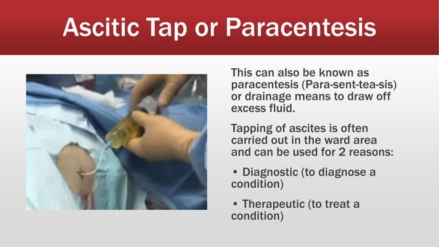 Ascitic tap or paracentesis | PPTX | First Aid | Injuries