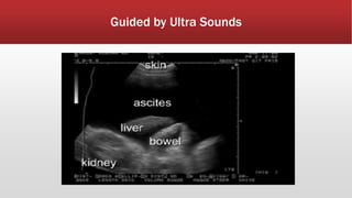 Ascitic tap or paracentesis | PPTX