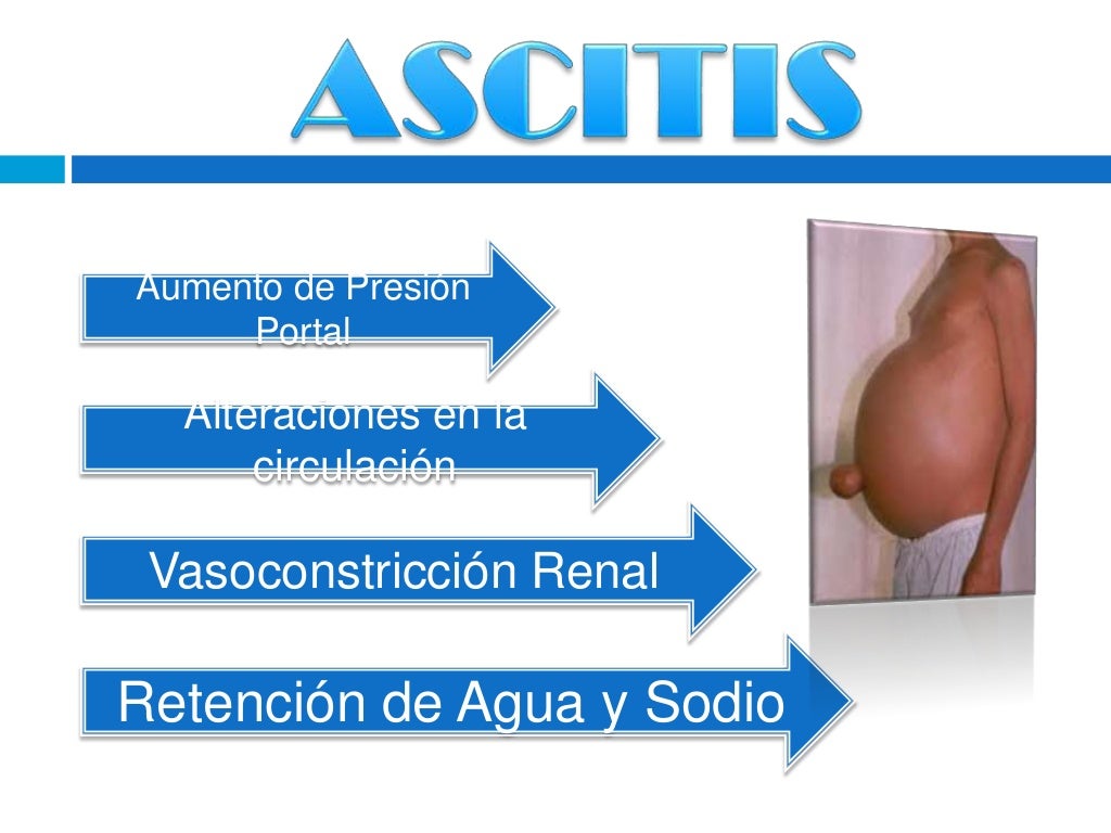 Ascitis