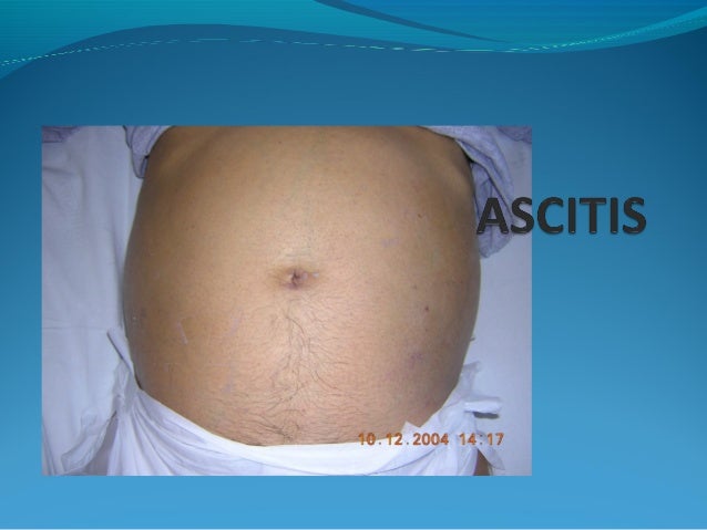 Ascitis