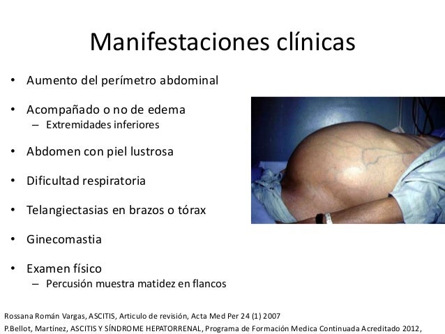 Ascitis