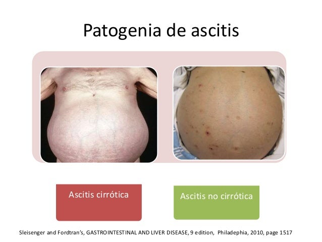 Ascitis