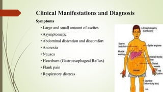 Ascitis | PPTX