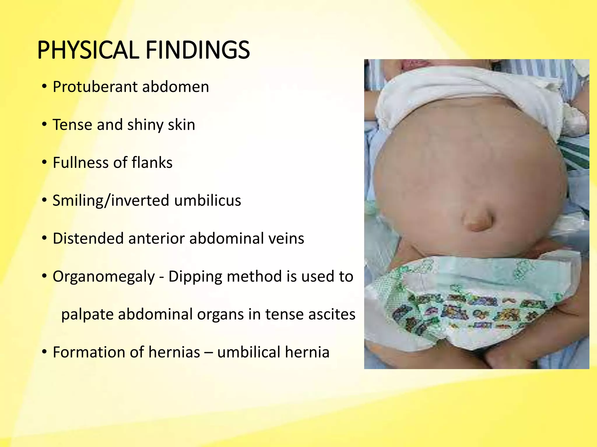 ASCITIS IN CHILDREN BY DR VIJITHA | PPTX