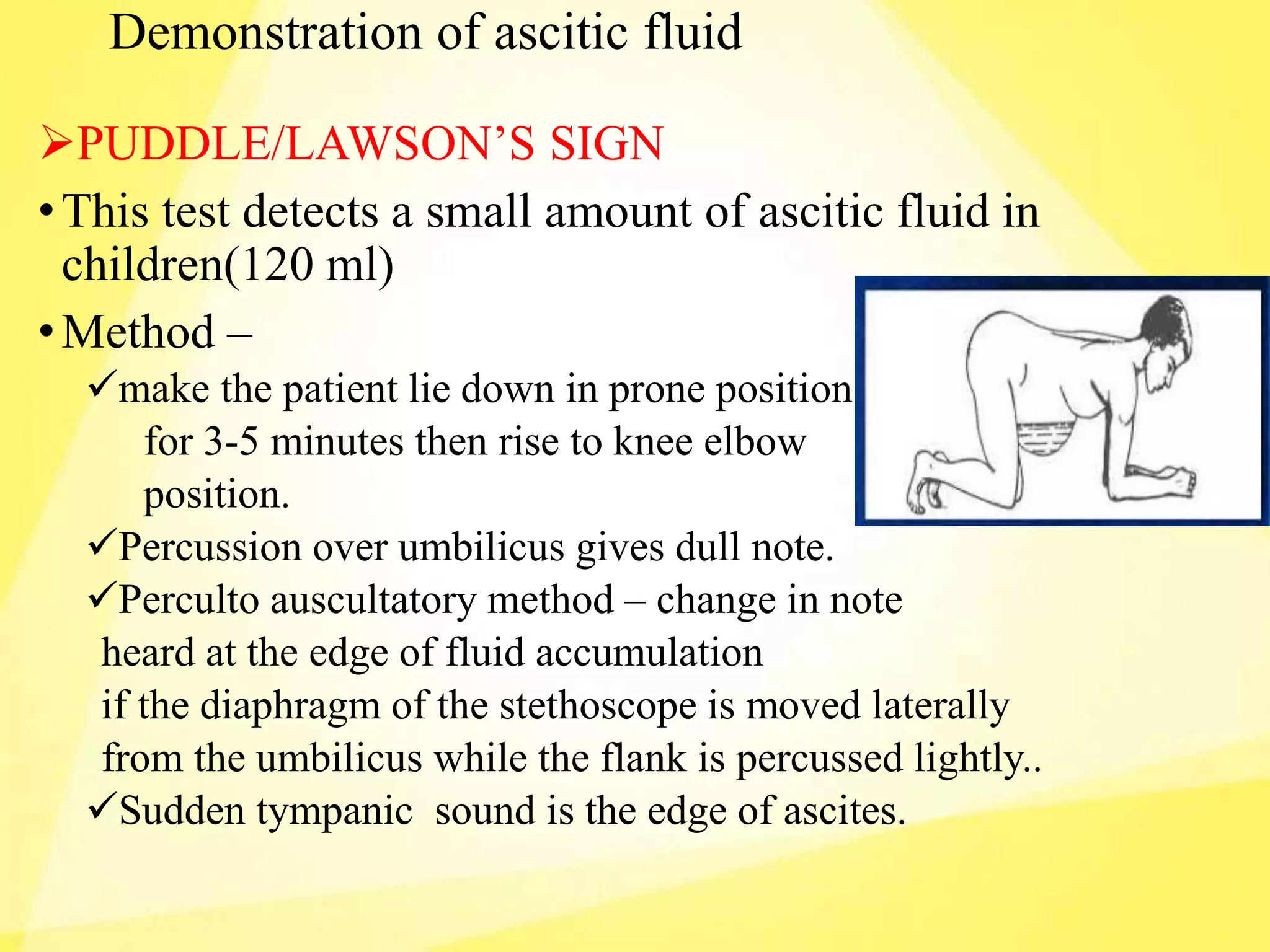 ASCITIS IN CHILDREN BY DR VIJITHA | PPTX