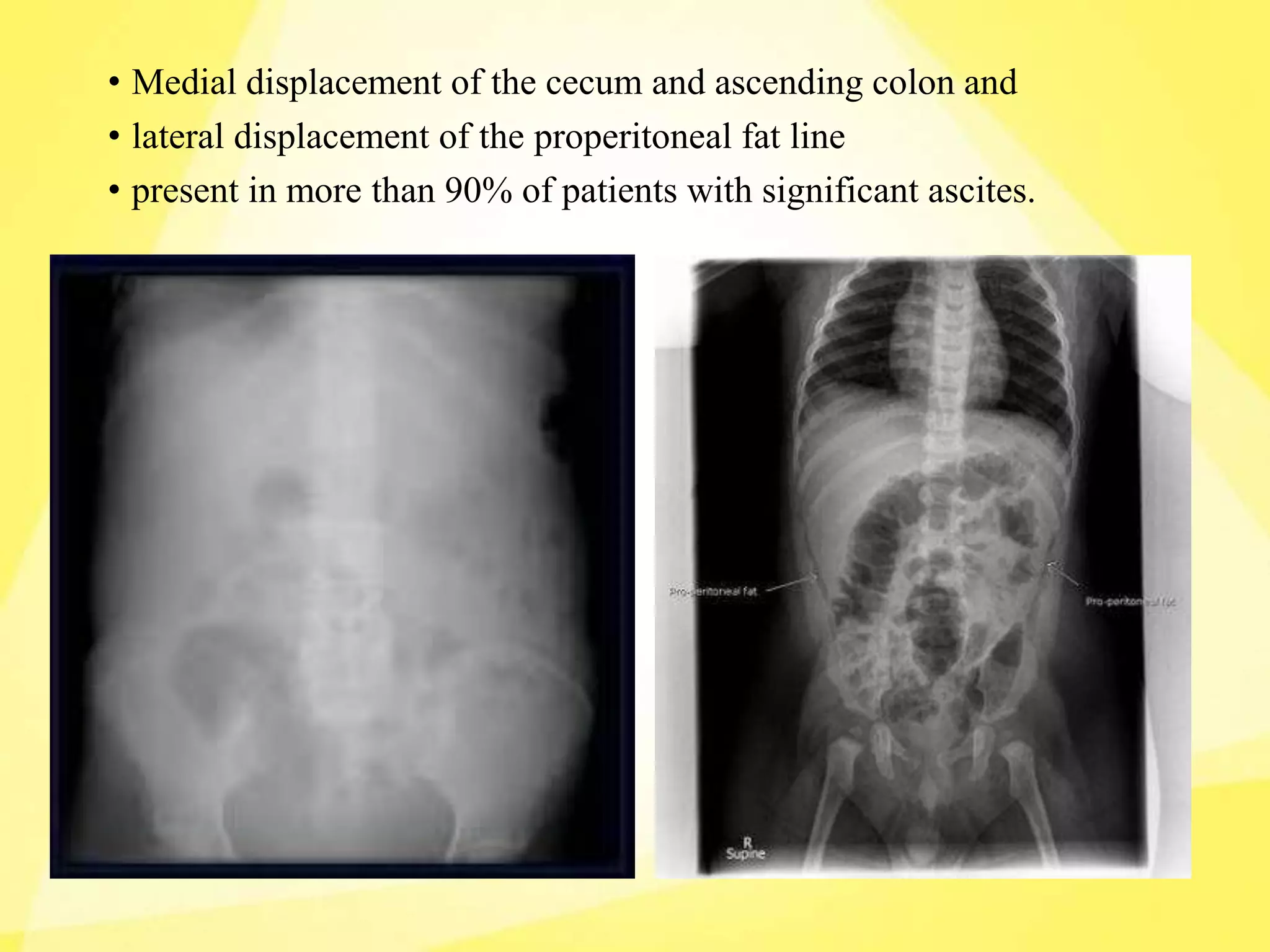 ASCITIS IN CHILDREN BY DR VIJITHA | PPTX