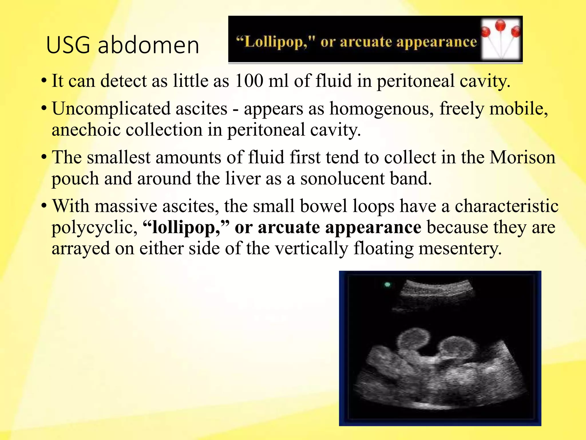 ASCITIS IN CHILDREN BY DR VIJITHA | PPTX