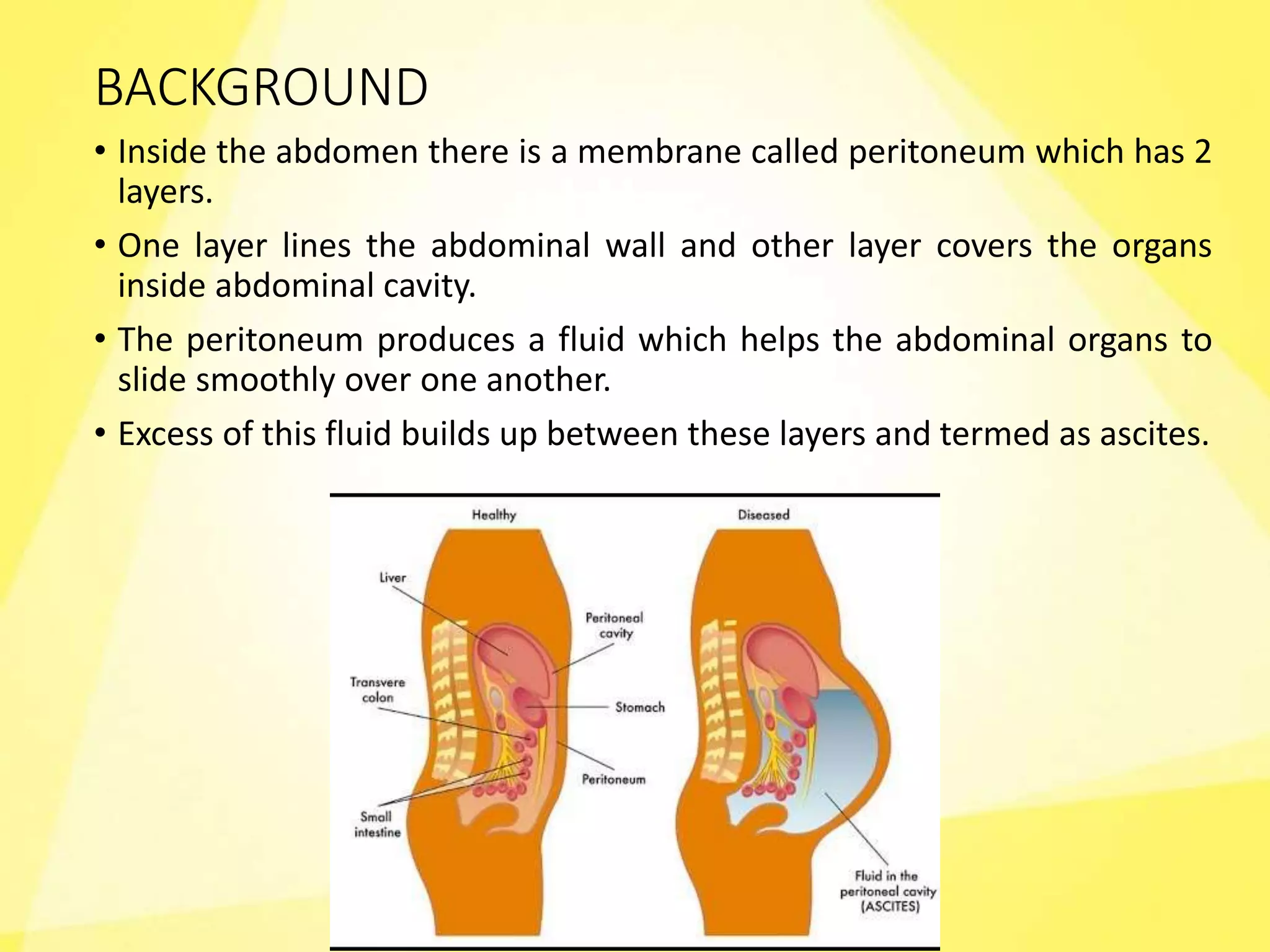 ASCITIS IN CHILDREN BY DR VIJITHA | PPTX