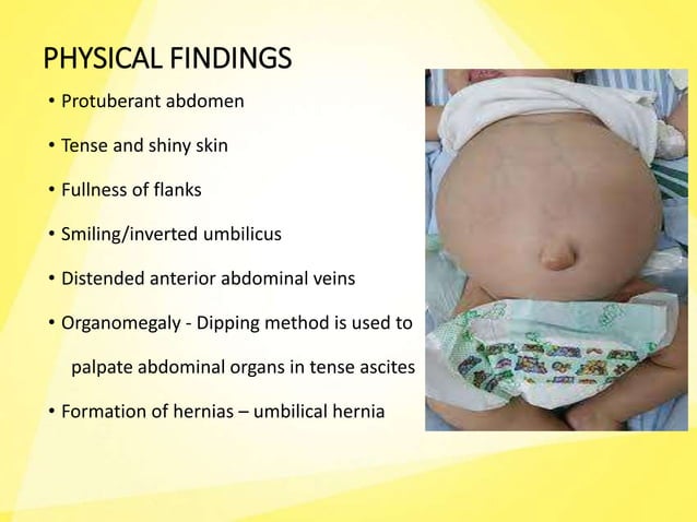 ASCITIS IN CHILDREN BY DR VIJITHA | PPTX