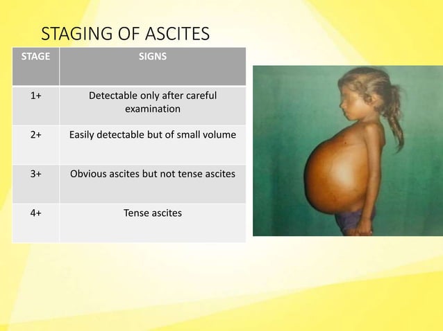 ASCITIS IN CHILDREN BY DR VIJITHA | PPTX