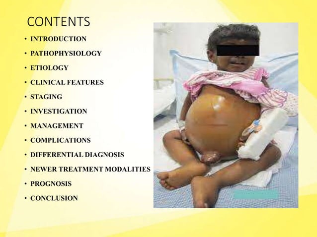 ASCITIS IN CHILDREN BY DR VIJITHA | PPTX