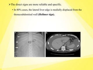 ASCITIS IN CHILDREN BY DR VIJITHA | PPTX