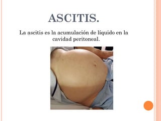 ASCITIS.pptx
