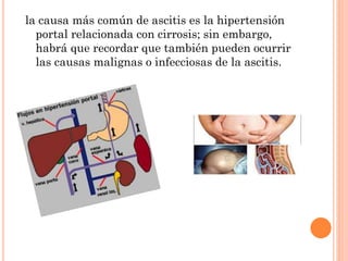 ASCITIS.pptx